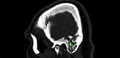 Sigmoid Sinus Diverticulum Dehiscence Bilateral Transverse Sinus