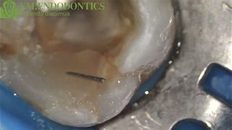 Broken Metal Segment Retrieval Using Ultrasonic Tip Retreatment Case Palatal Canal Youtube