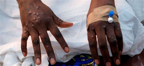 How Truck Drivers Sex Workers Drive Mpox Across Borders