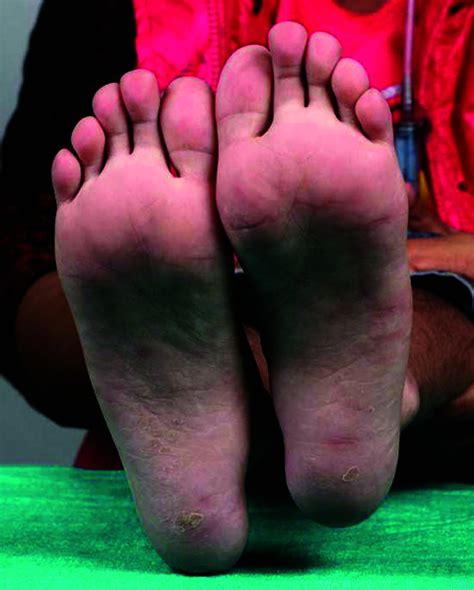 Palmoplantar Keratoderma As The Preceding Cutaneous Manifestation Of