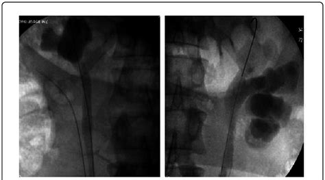 Intra Operative Retrograde Pyelogram Showing The Patients Upper Download Scientific Diagram