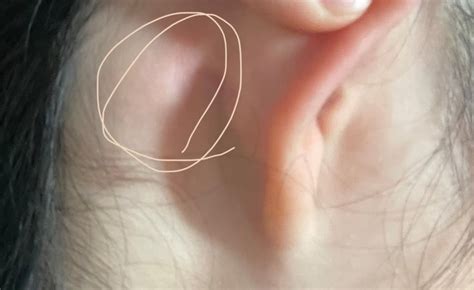 귀 뒤 뼈 혹 멍울 지식in