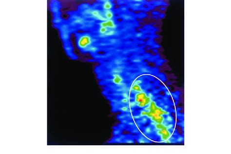 [ 18 F]fluorodeoxyglucose Positron Emission Tomography Image Showing Download Scientific