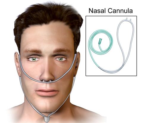 Indikasi Nasal Kanul Alomedika