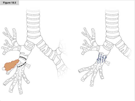 Bronchial Sleeve Resection Thoracic Key
