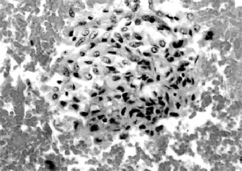 Cell Block Of Gist Syncytial Aggregates Of Spindle Or Oval Cells Are