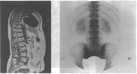This Patient With Prostate Cancer Had A Normal Bone Scan And A Raised Download Scientific