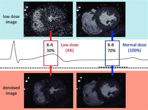 image noise reduction by artificial intelligence in multiphase cardiac