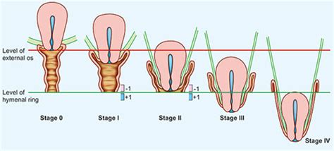 Uterine Prolapse Degrees