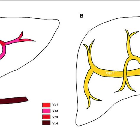 Liver Transplantation For Hcc Patients With Pvtt Download Scientific Diagram