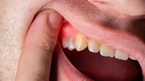 Causes Of Red Sore On Gums