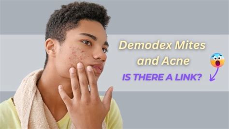 Understanding Demodex Mites Role In Common Skin Woes Ozidex