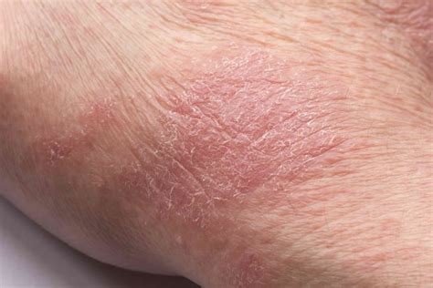 Man Presents With Diffuse Pruritus Mdedge