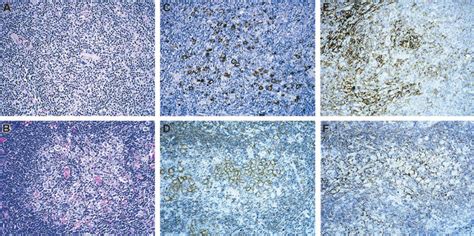 Patterns Of Nlphl With T Cell Histiocyte Rich Nodules Pattern A Top Download Scientific