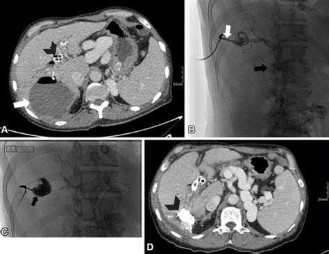 Biliary Leaks Multidisciplinary Approach To Diagnosis And Treatment