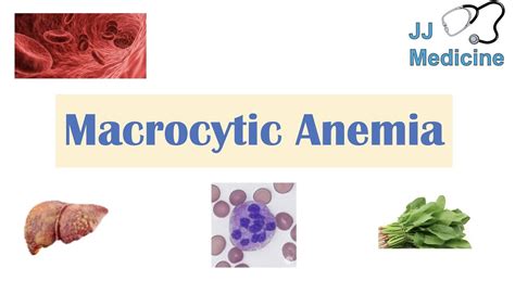 Macrocytic Anemia Megaloblastic Vs Non Megaloblastic Approach And Causes