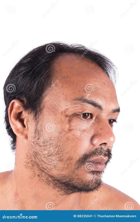Stitch Scars On The Face Stock Image Image Of Adult
