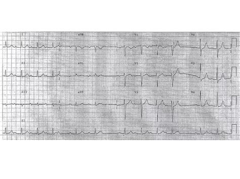 Ecg Lecture Sinus Arrest Sinoatrial Exit Block Av Block And Escape Rhythms Ppt