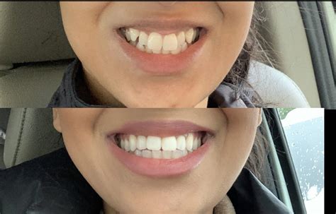 My Braces Served Me Well For The Last 8 Months Since Getting Them Off