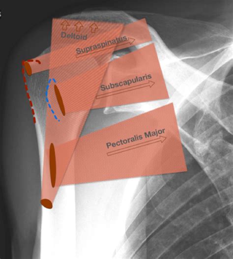 Figure 2 From Neer Classification How Do We Use It And Why Is It Important Semantic Scholar
