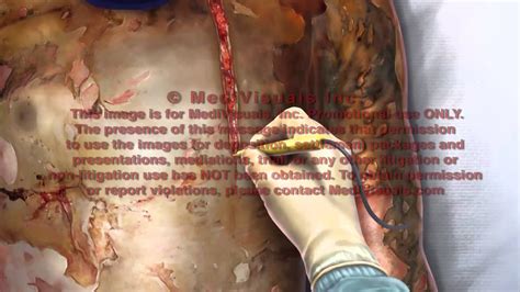 Escharotomy Surgery Youtube