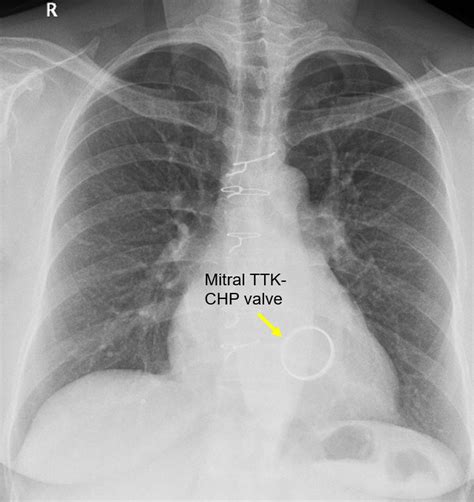 Prosthetic Heart Valves On Cxr All About Cardiovascular System And Disorders