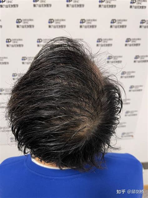 难以想象不植发能达到这样的效果！ 知乎