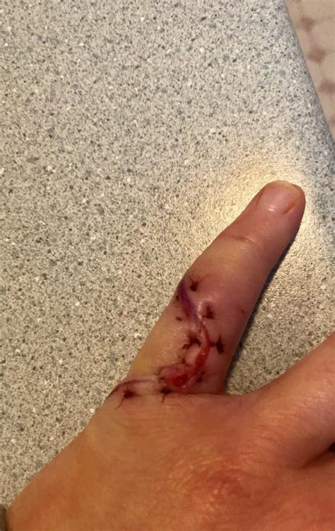 My Fifth Finger Before And After Orif Bonus Incision Pic For Fun R Radiology