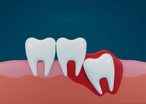 Premium Photo 3d Render Of Teeth With Wisdom Mesial Impaction