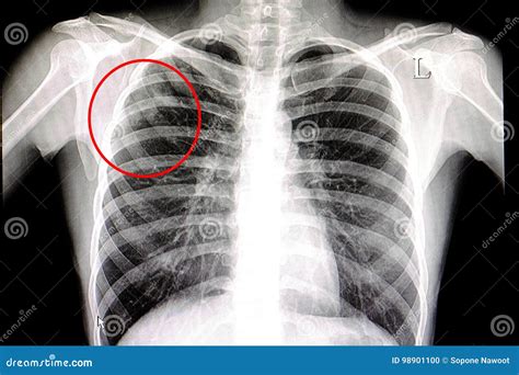 Pulmonary Tuberculosis Xray