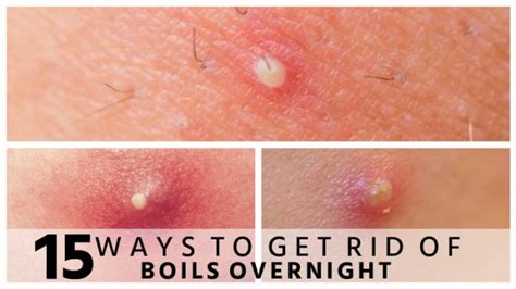 Best Effective Natural Home Remedies For Boils Skin Abscesses