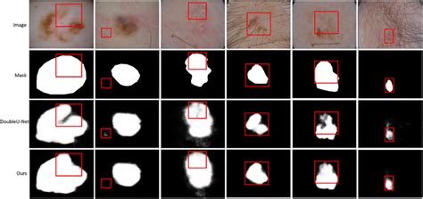 Visualization Results Of Doubleu Netsfsm On Isic 2018 Test Set For