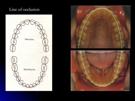 Classification Of Normal Occlusion And Malocclusion Ppt Dental