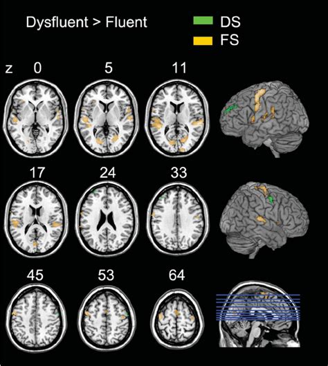 Activation Patterns For The Contrast Of Dysfluent Speech Over Fluent Download Scientific