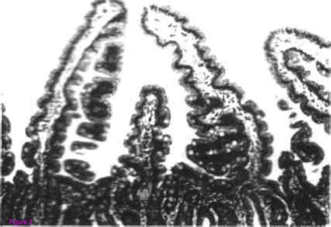 Total Villous Atrophy With Crypt Hyperplasia Of The Second Portion Of Download Scientific