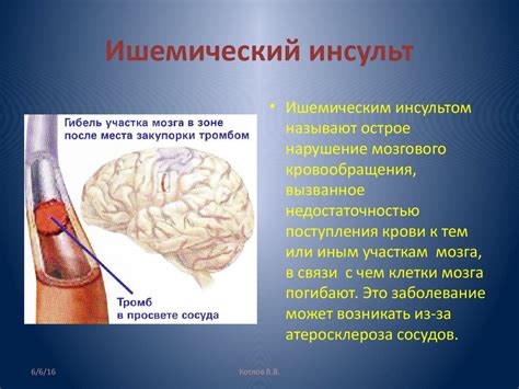 Инсульт. Виды инсульта - презентация онлайн