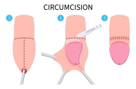 Circumcision Questions And Answers