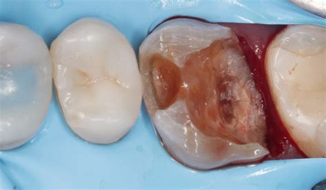 Clinical Case Direct Cuspal Coverage With Resin Composite