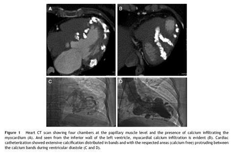 Heart Calcification Idiopathic Cardiac Osseous Metaplasia A Case Report