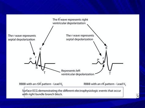 Ecg Rbbb With Lafb Ppt
