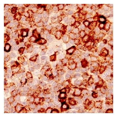 Positive Immunohistochemical Staining For Cd43 Download Scientific