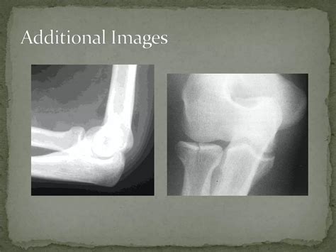 Radial Head Fracture Ppt
