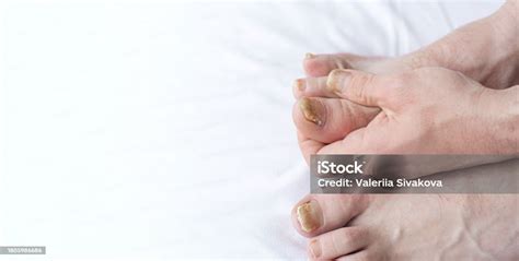 손톱 균류로 손톱을 자른 남성 손 다리에 곰팡이 감염 손발톱 진균증이있는 손가락 관리 및 치료 곰팡이 때문에 손톱이 손상된 발 클로즈업 건강관리와 의술에 대한 스톡 사진 및