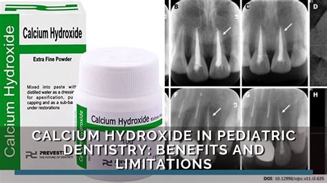 Calcium Hydroxide In Pediatric Dentistry Benefits And Limitations