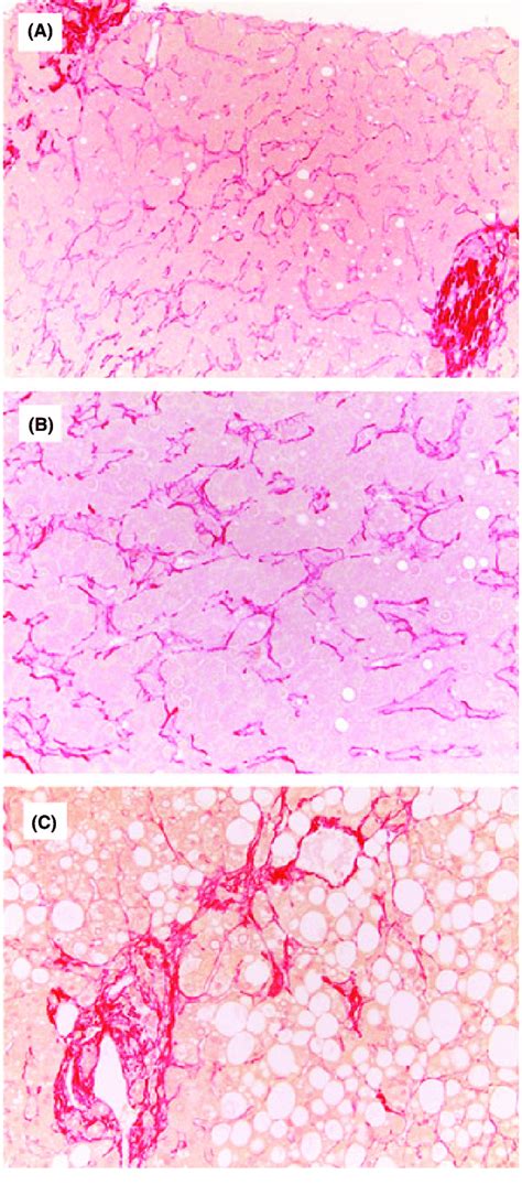 The Diffuse Subsinusoidal Pattern Of Fibrosis The Phenotype In Adult Download Scientific