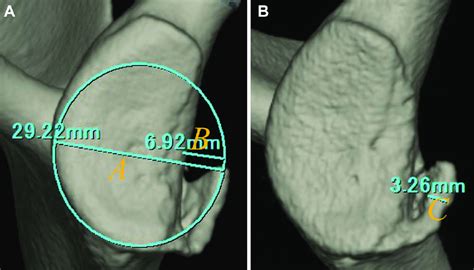 Quantification Method For The Glenoid Defect Size And Bone Fragment