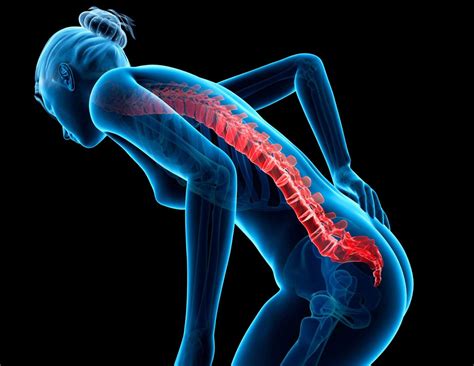 The Ultimate Guide To Dry Needling For Sciatica