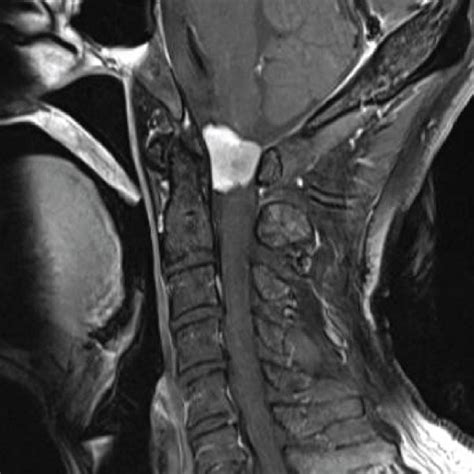 A T2 Weighted Sagittal Mri Of The Cervical Spine Showed A Tumor In