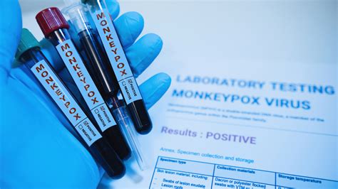 ჯანმომ მაიმუნის ყვავილთან დაკავშირებით გლობალური საგანგებო მდგომარეობა გამოაცხადა Netgazeti