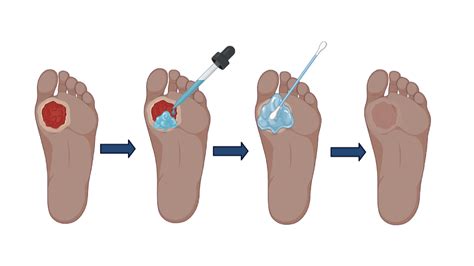 🦶 The 35 Billion Ulcer Problem Can Hydrogels Fix Chronic Wounds